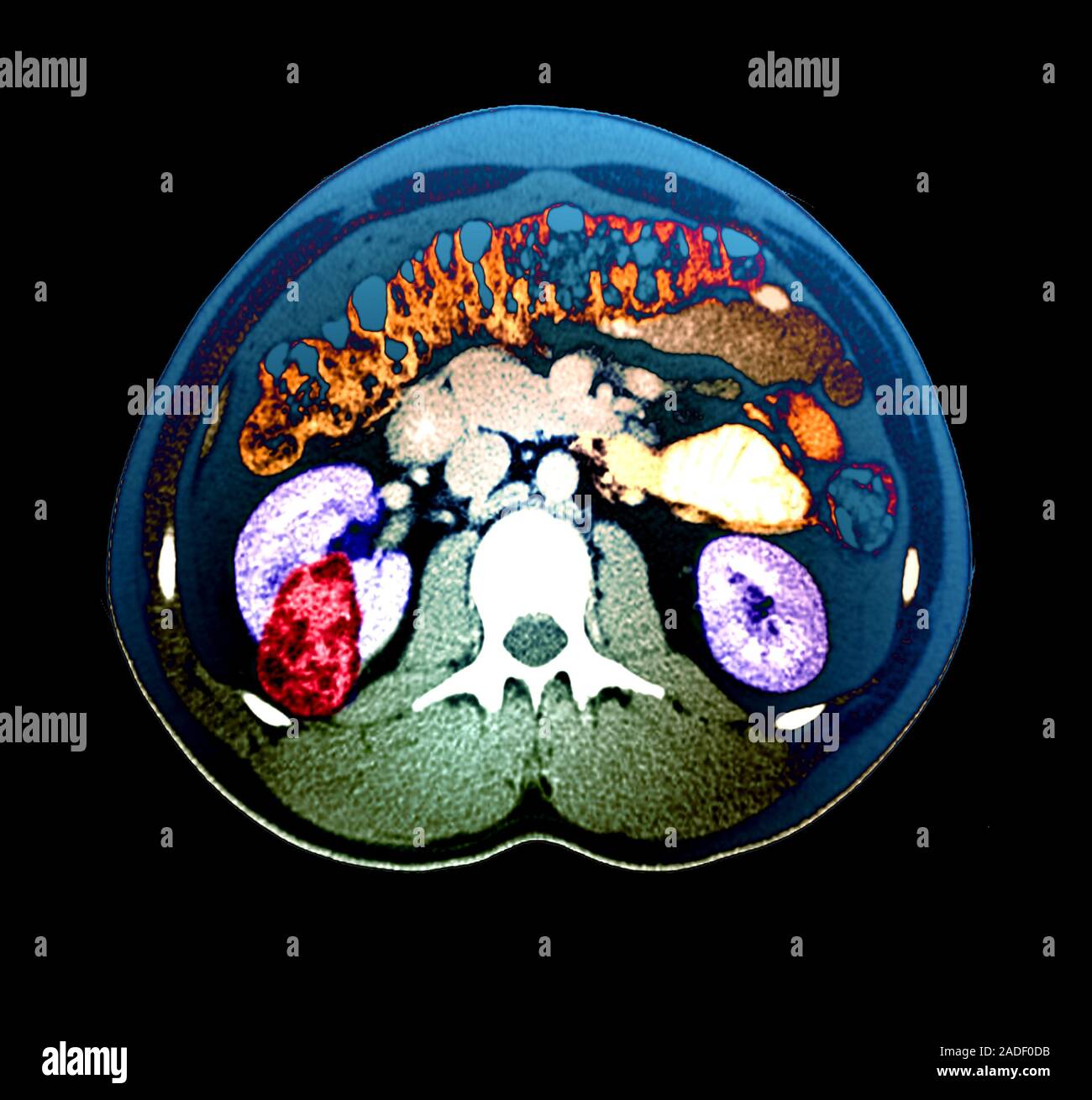 Renal cancer. Coloured computed tomography (CT) scan of an axial section of the abdomen of a 57 ...