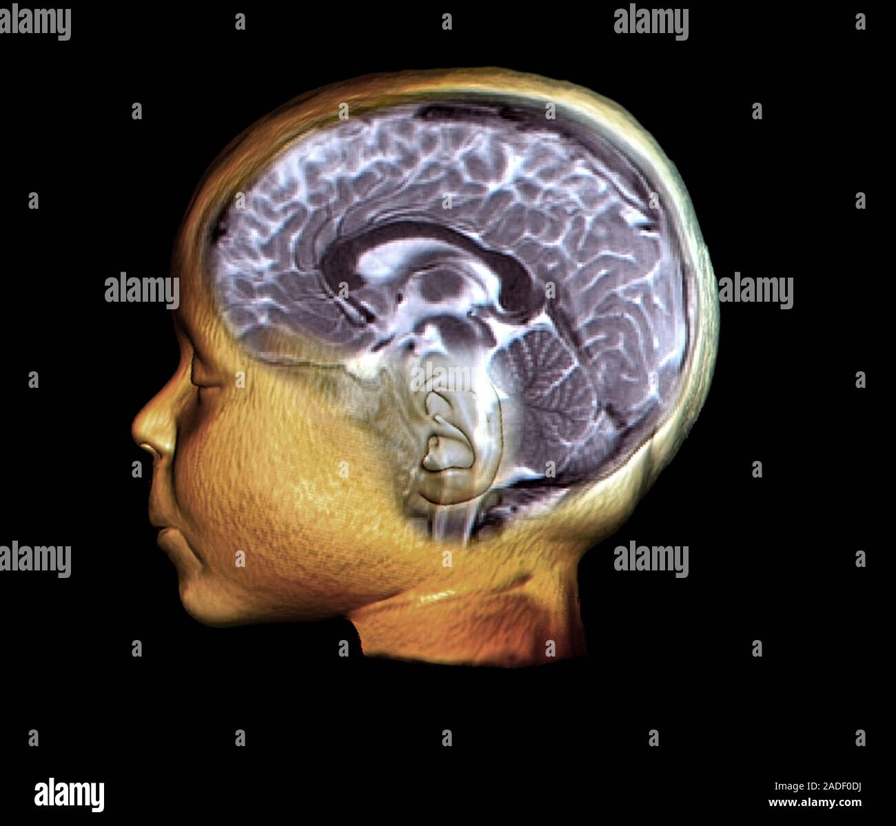 Child's head and brain. Coloured magnetic resonance imaging (MRI) scan ...
