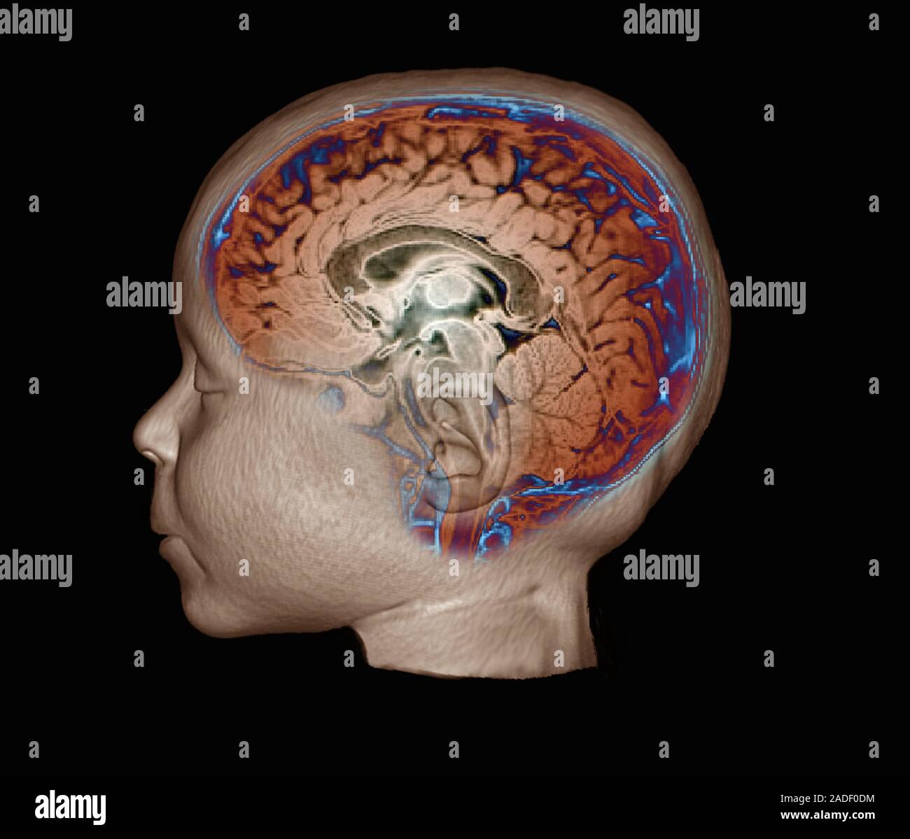 Child's head and brain. Coloured magnetic resonance imaging (MRI) scan ...