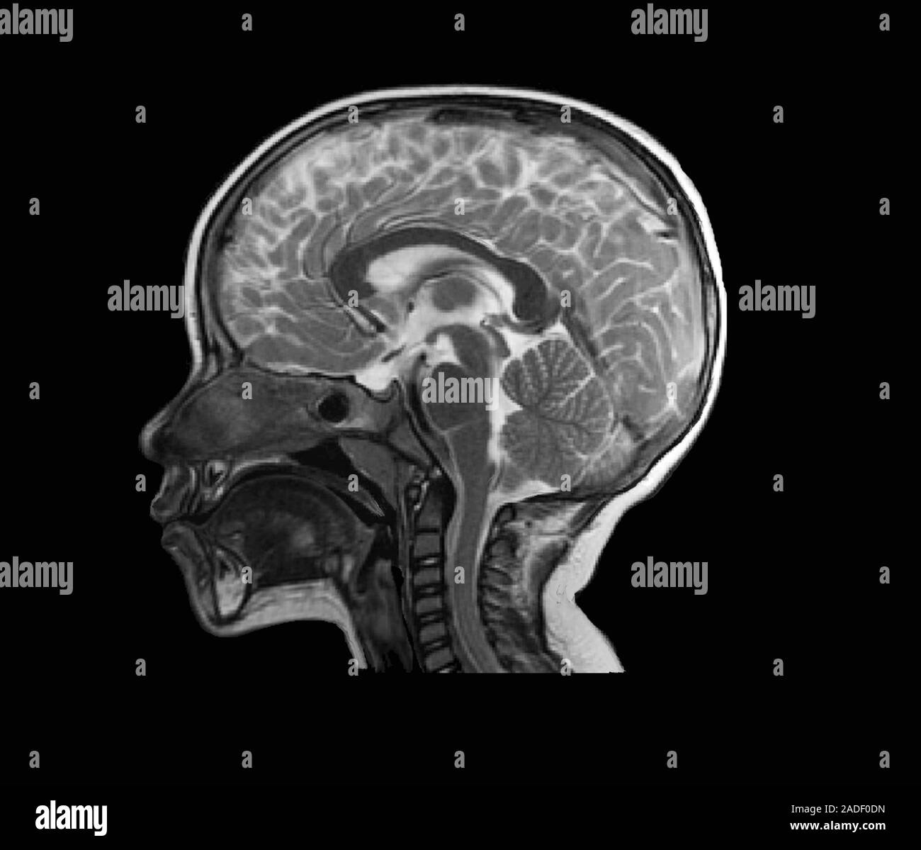 Child's head and brain. Magnetic resonance imaging (MRI) scan of a ...