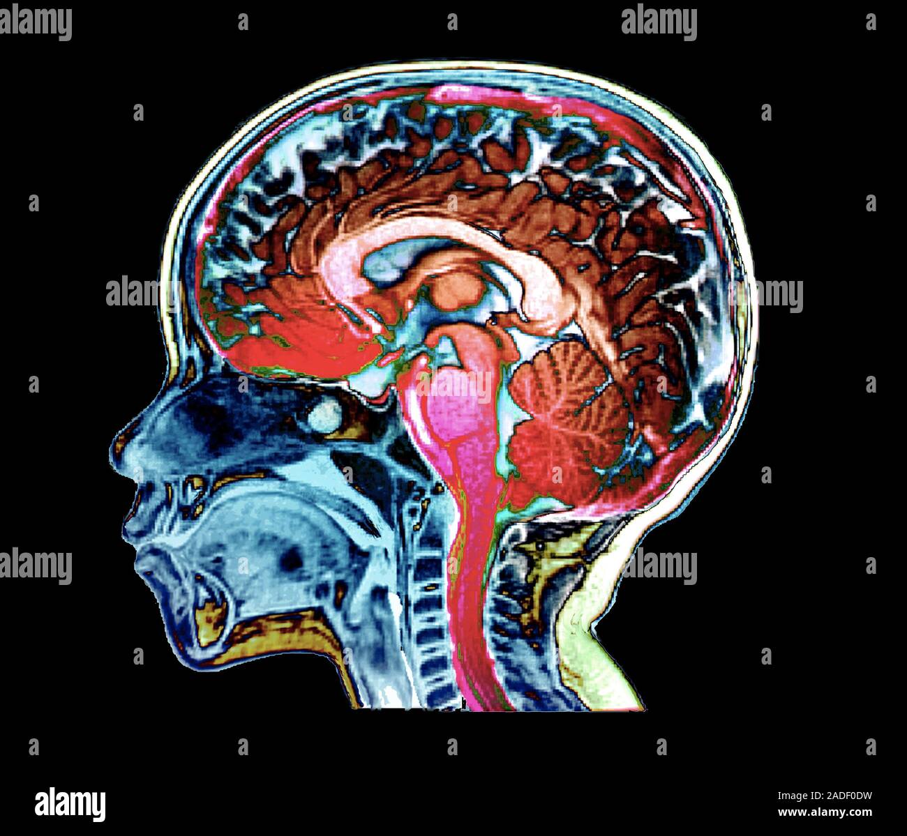 Child's head and brain. Coloured magnetic resonance imaging (MRI) scan ...
