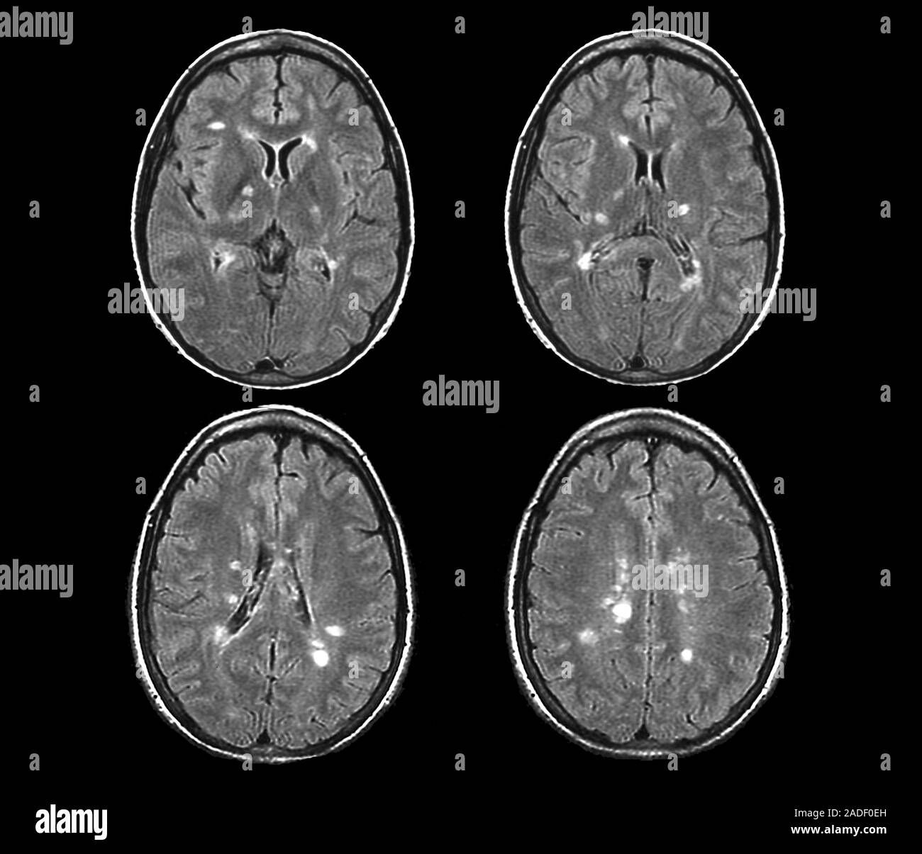 Multiple sclerosis. Magnetic resonance imaging (MRI) scans of contiguous axial sections of the ...