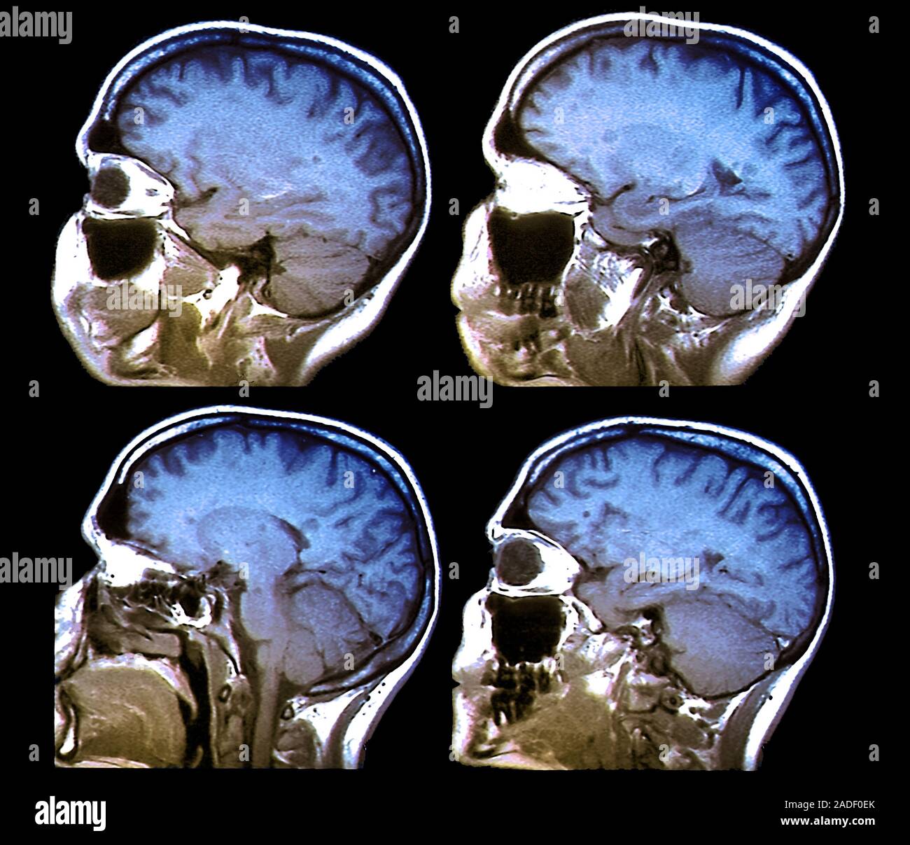 Multiple sclerosis. Coloured magnetic resonance imaging (MRI) scans of ...