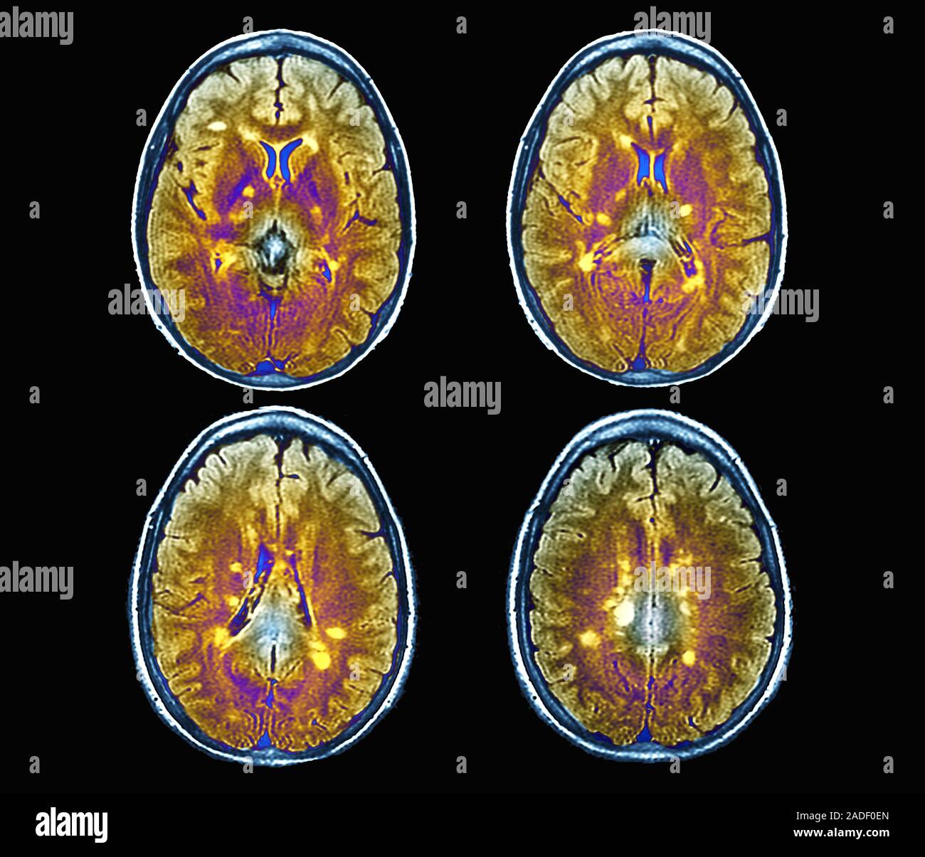 Multiple sclerosis. Coloured magnetic resonance imaging (MRI) scans of contiguous axial sections ...