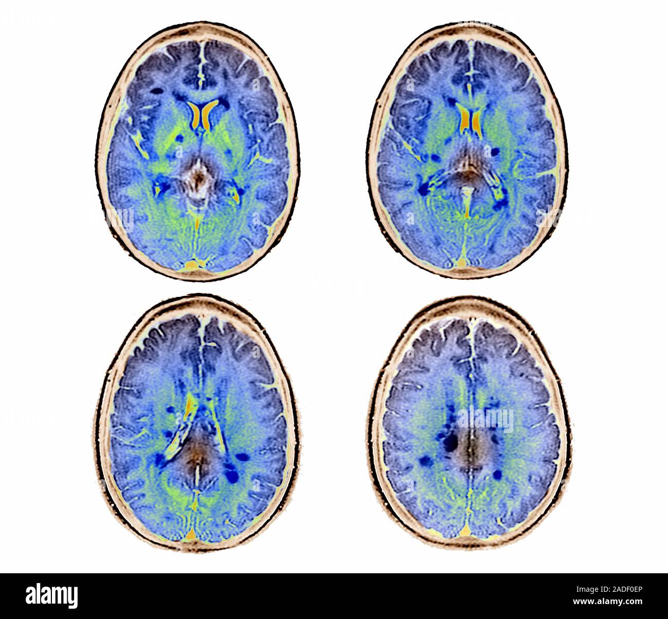 Multiple sclerosis. Coloured magnetic resonance imaging (MRI) scans of contiguous axial sections ...