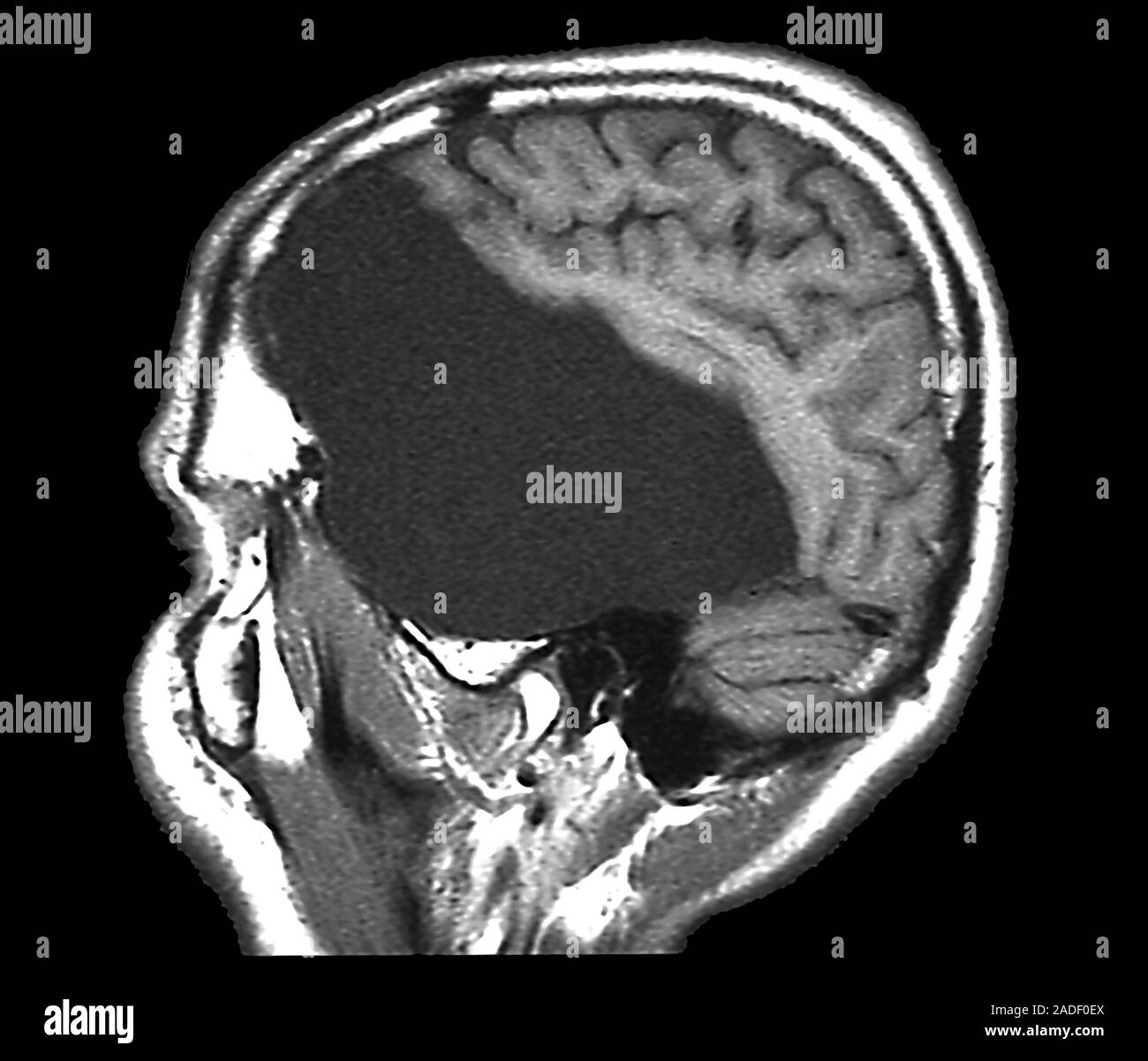 Large arachnoid cyst. Magnetic resonance imaging (MRI) scan of a ...