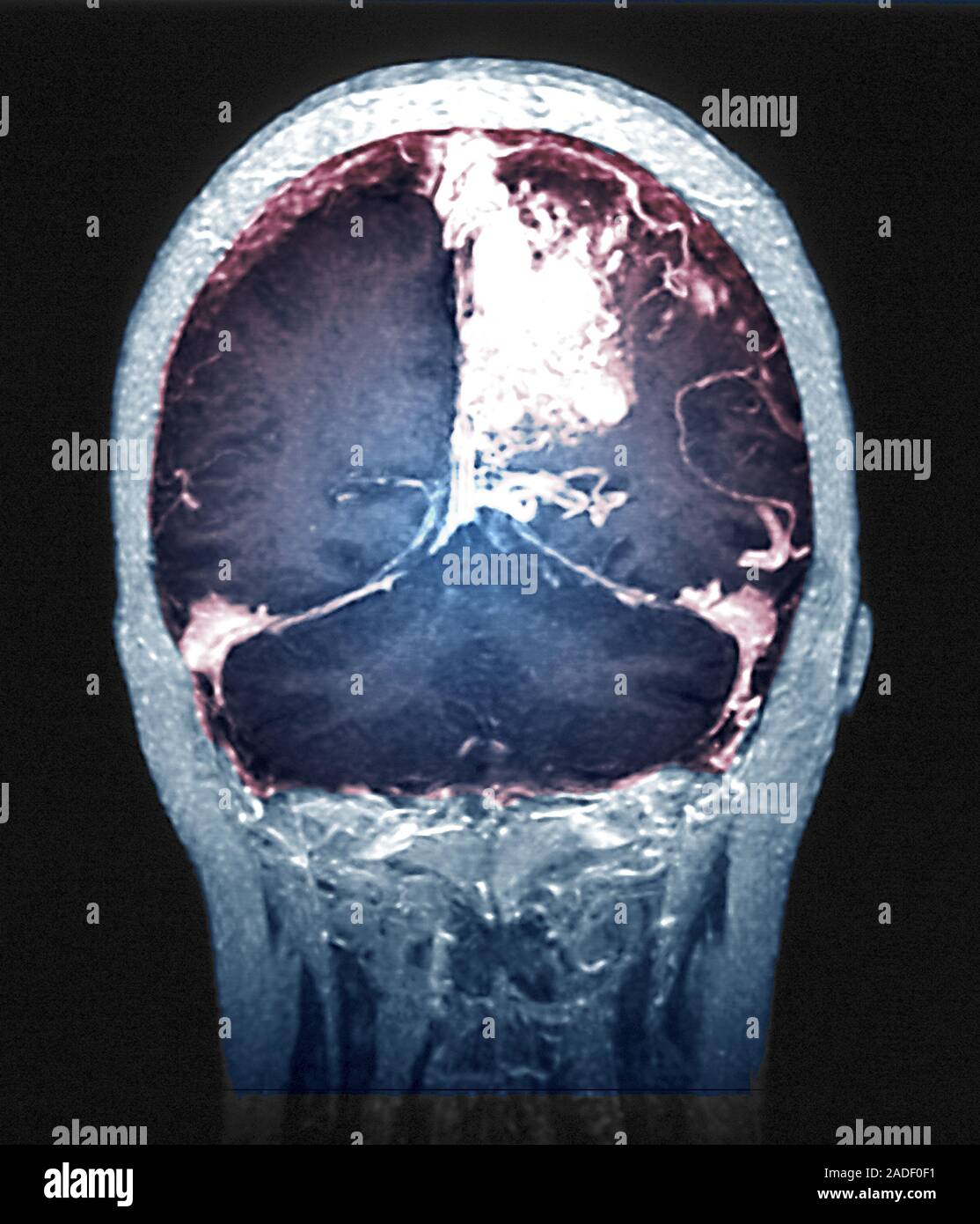 Cerebral arteriovenous malformation. Coloured magnetic resonance ...