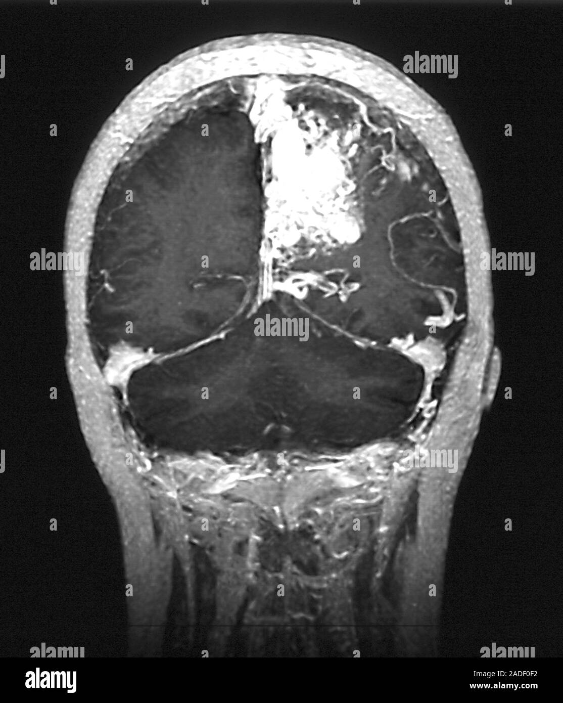 Cerebral arteriovenous malformation. Magnetic resonance angiogram (MRA ...