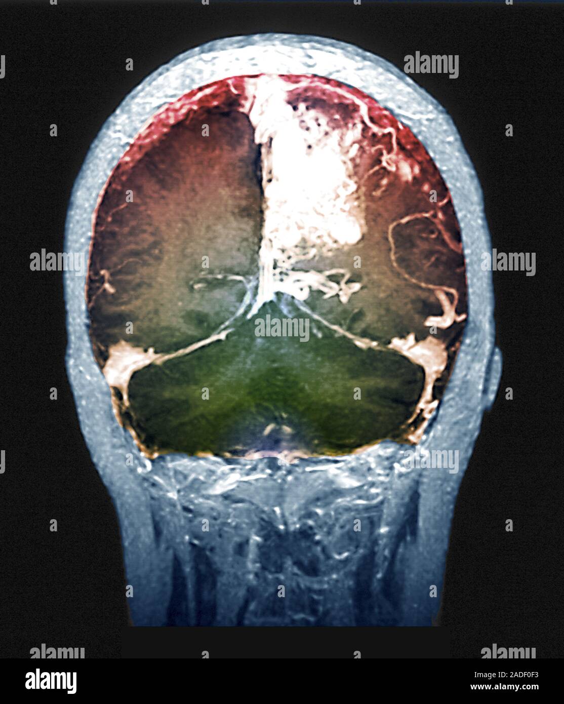 Cerebral arteriovenous malformation. Coloured magnetic resonance ...