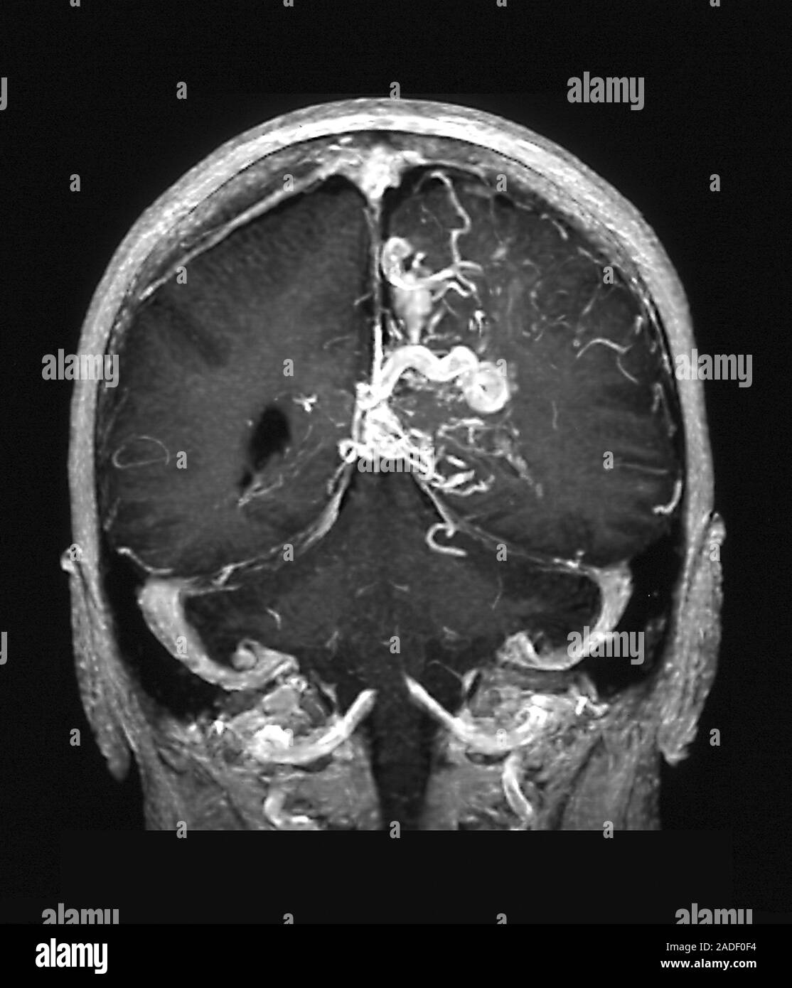 Cerebral arteriovenous malformation. Magnetic resonance angiogram (MRA ...