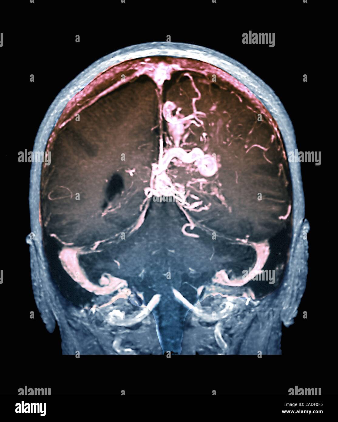 Cerebral arteriovenous malformation. Coloured magnetic resonance ...