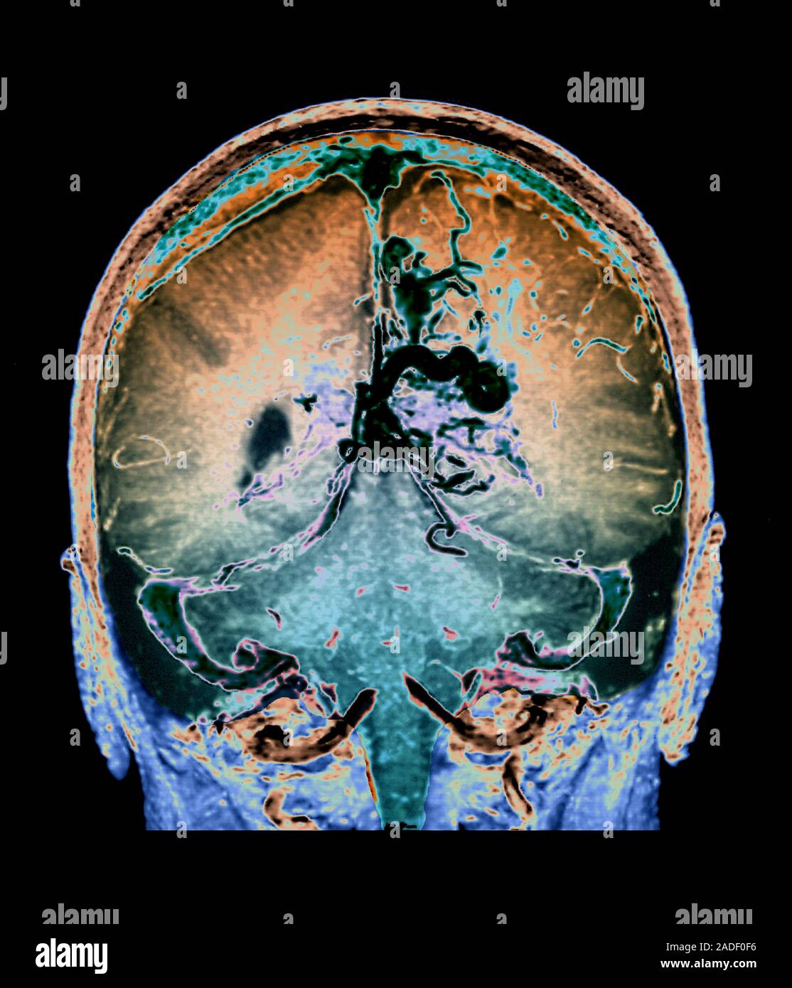 Cerebral arteriovenous malformation. Coloured magnetic resonance ...