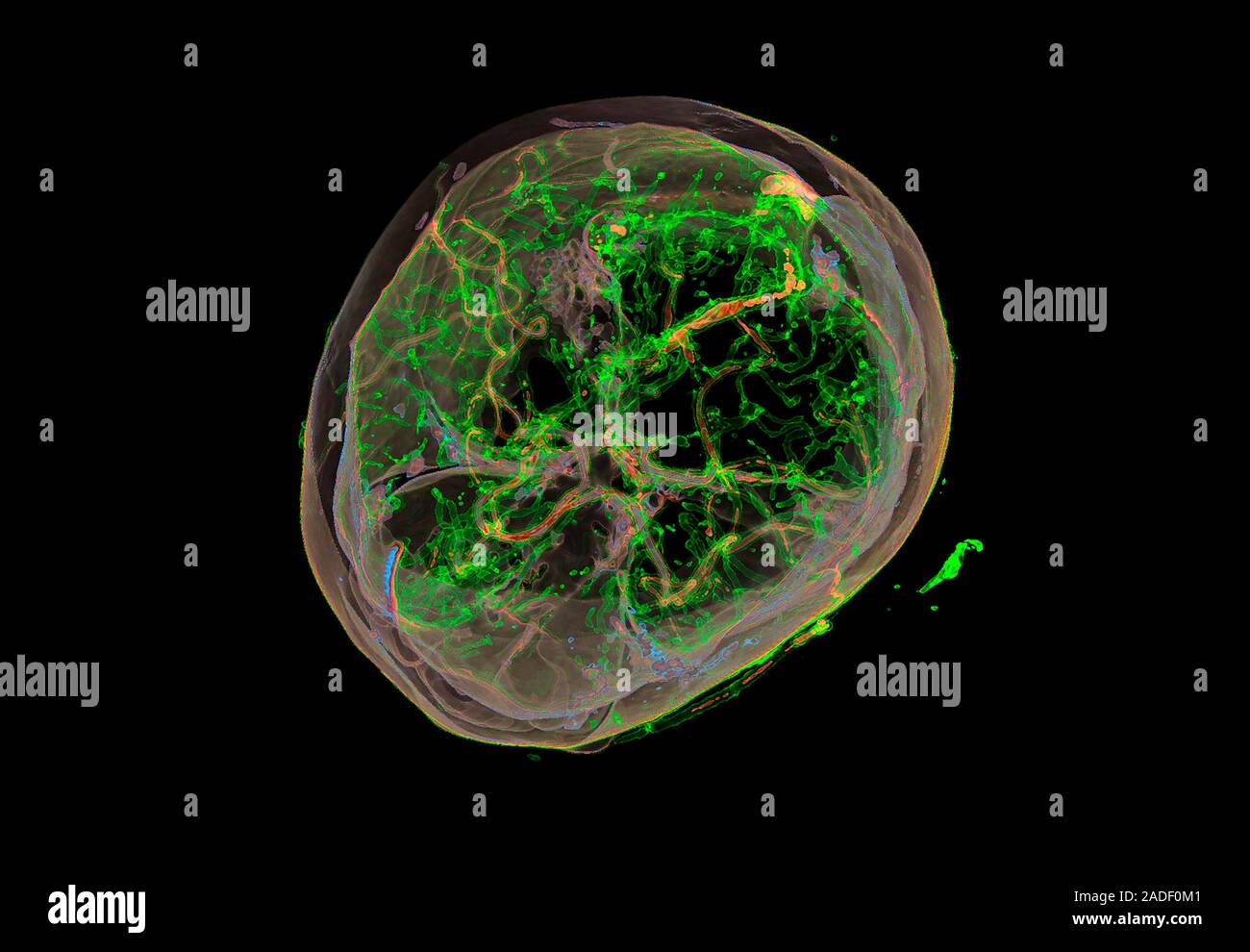 Human brain and skull, coloured computed tomography (CT) angiogram. This imaging technique shows ...