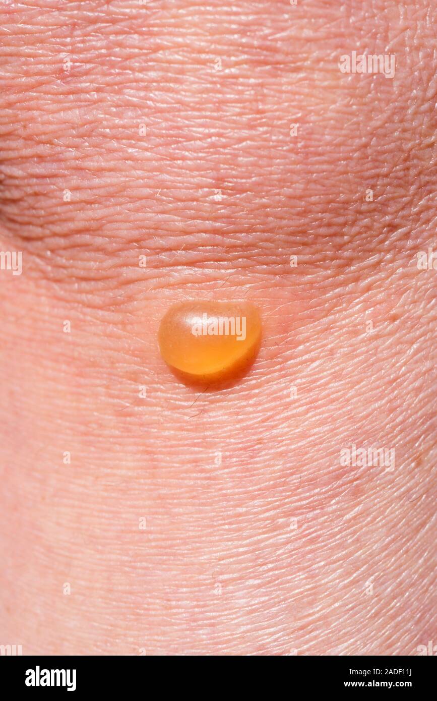 Allergic reaction to an insect bite under the knee of a 60 year old ...