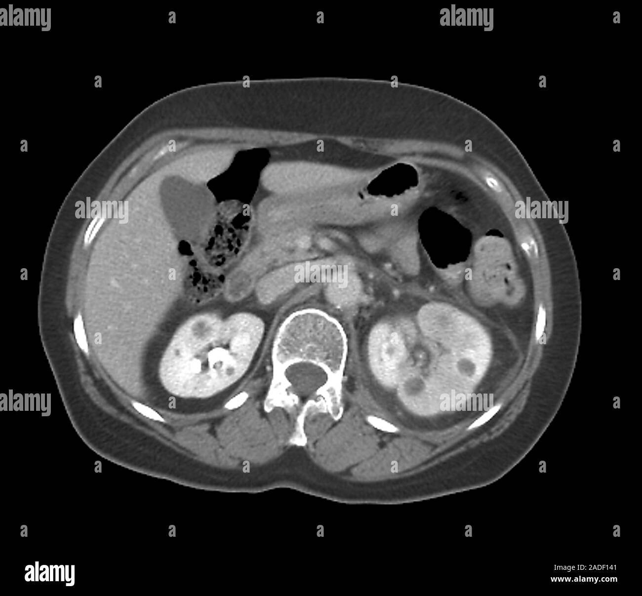 Pyelonephritis. Axial computed tomography (CT) scan through the abdomen ...
