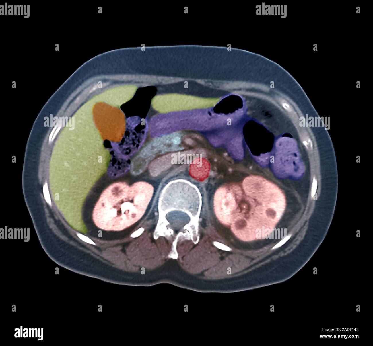 Pyelonephritis. Coloured axial computed tomography (CT) scan through ...