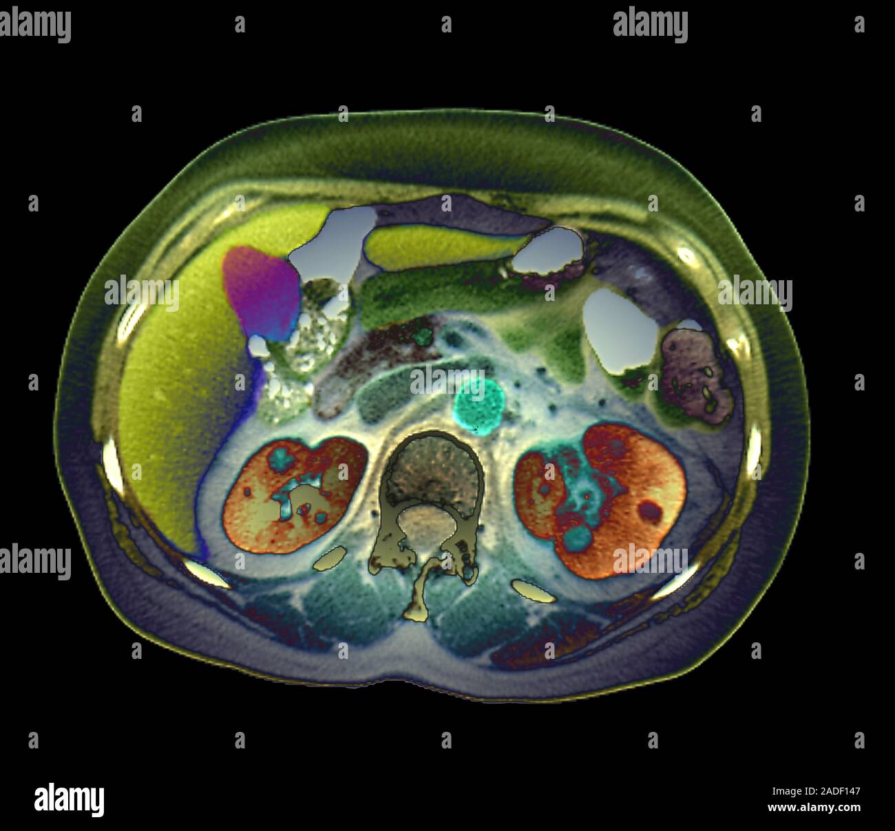 Pyelonephritis. Coloured axial computed tomography (CT) scan through ...