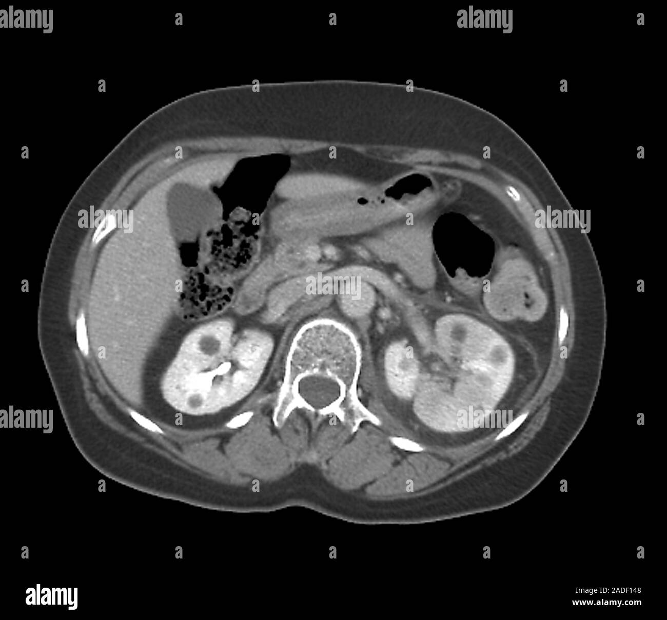 Pyelonephritis. Axial computed tomography (CT) scan through the abdomen ...