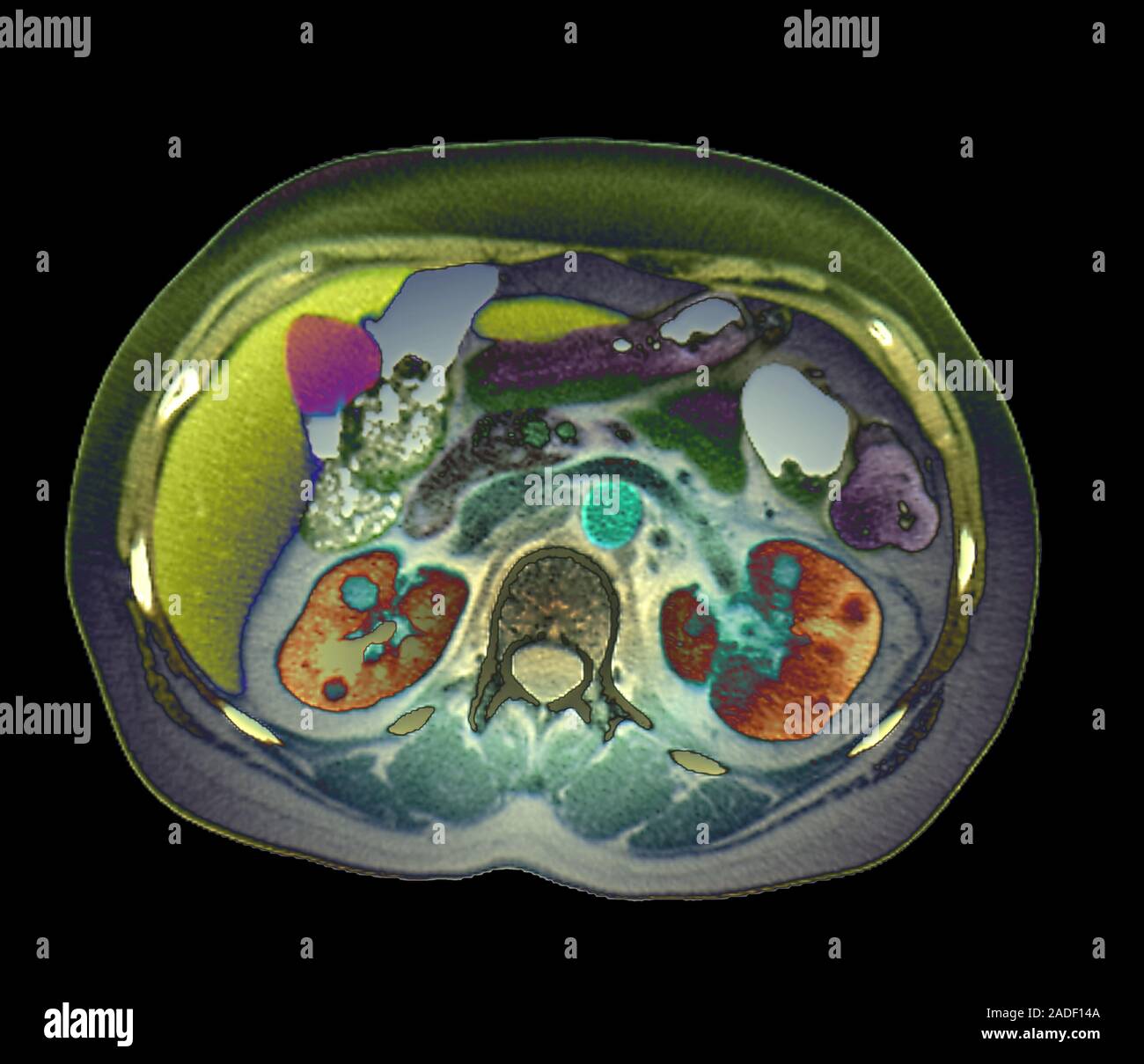 Pyelonephritis. Coloured axial computed tomography (CT) scan through ...
