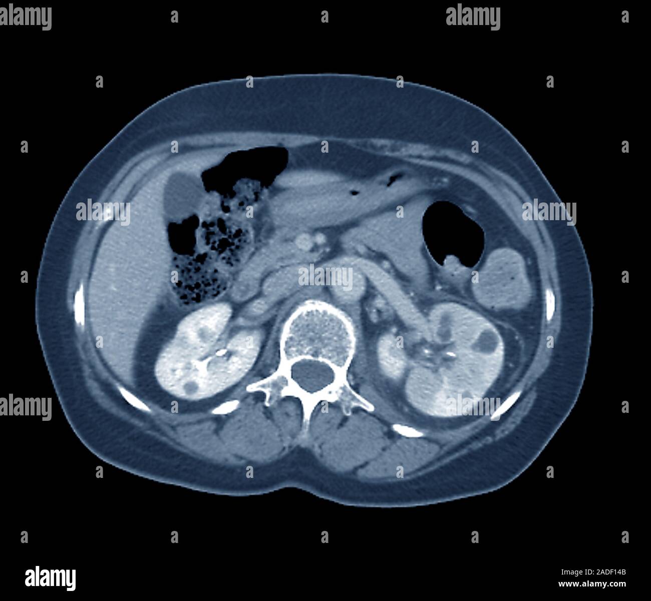 Pyelonephritis. Axial computed tomography (CT) scan through the abdomen ...