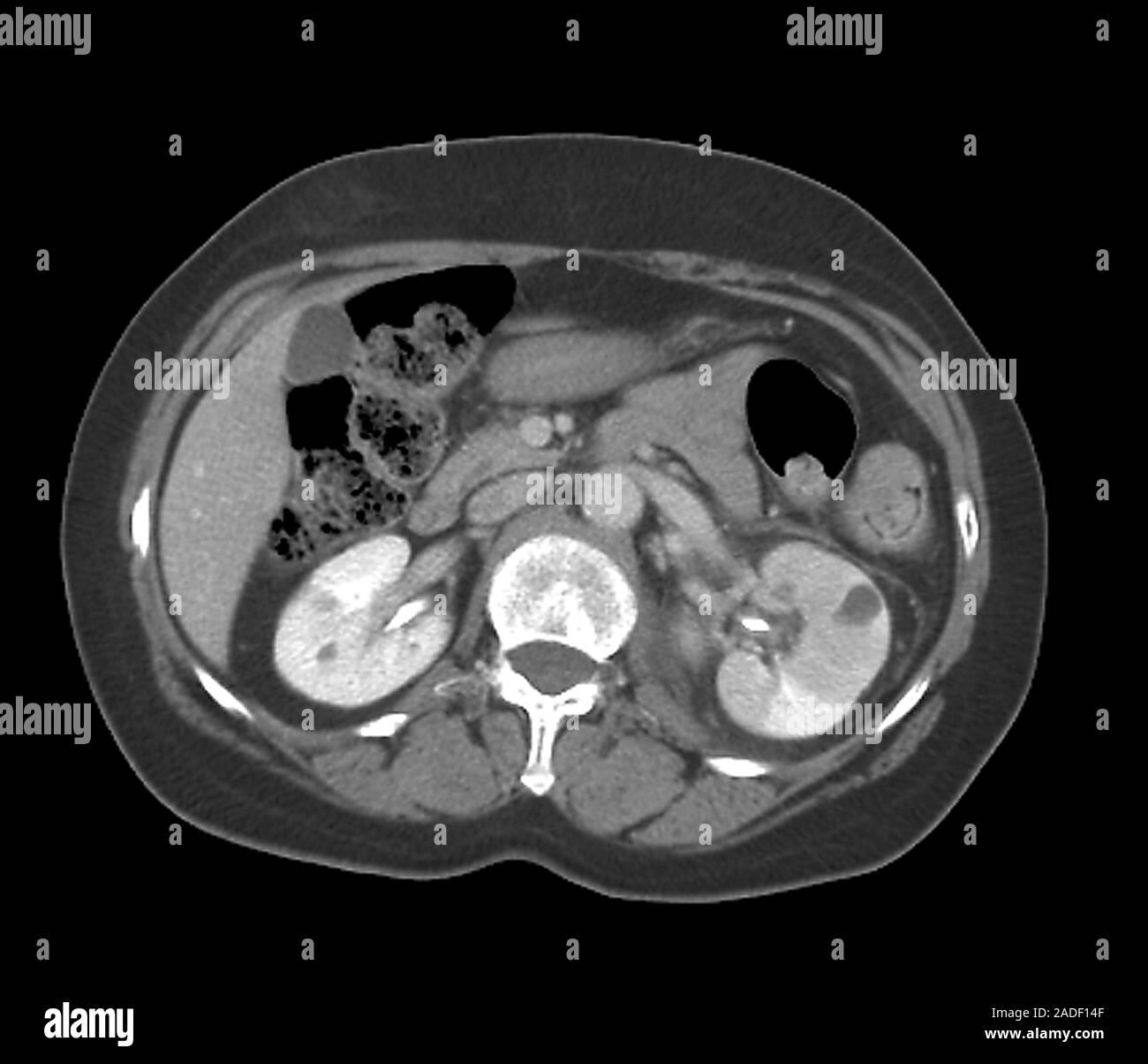 Pyelonephritis. Axial computed tomography (CT) scan through the abdomen ...