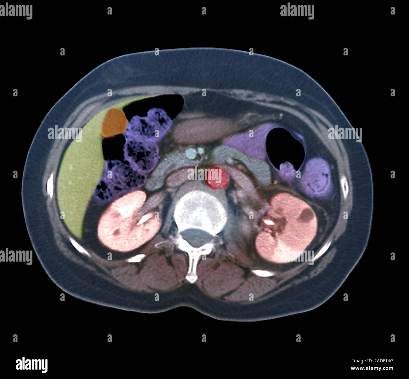 Pyelonephritis Coloured Axial Computed Tomography Ct Scan Through The Abdomen Of A 54 Year