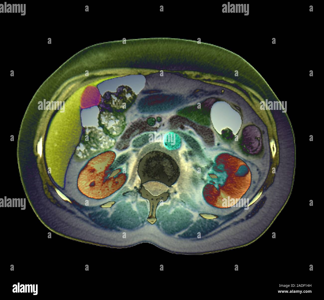Pyelonephritis. Coloured axial computed tomography (CT) scan through ...