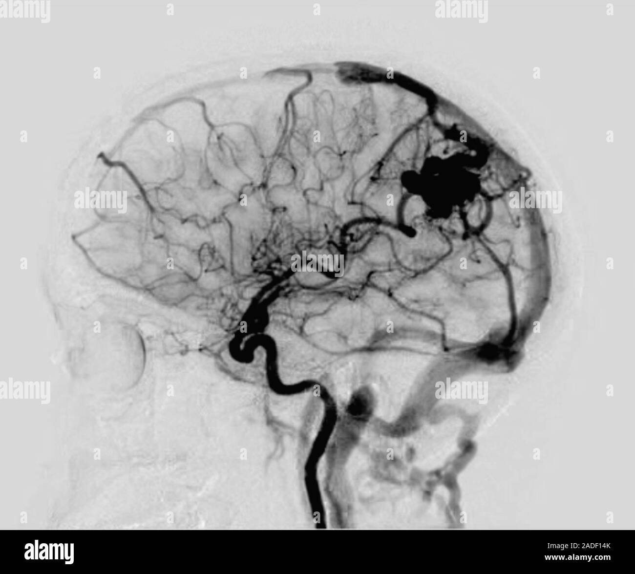 Cerebral arteriovenous malformation. Lateral X-ray of the skull and ...