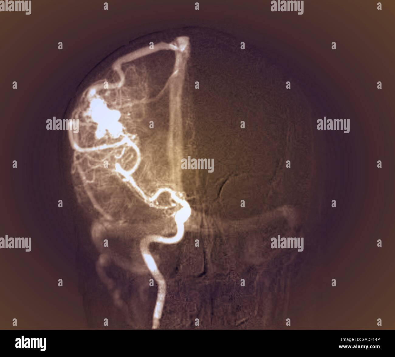 Cerebral arteriovenous malformation. Frontal X-ray of the skull and ...
