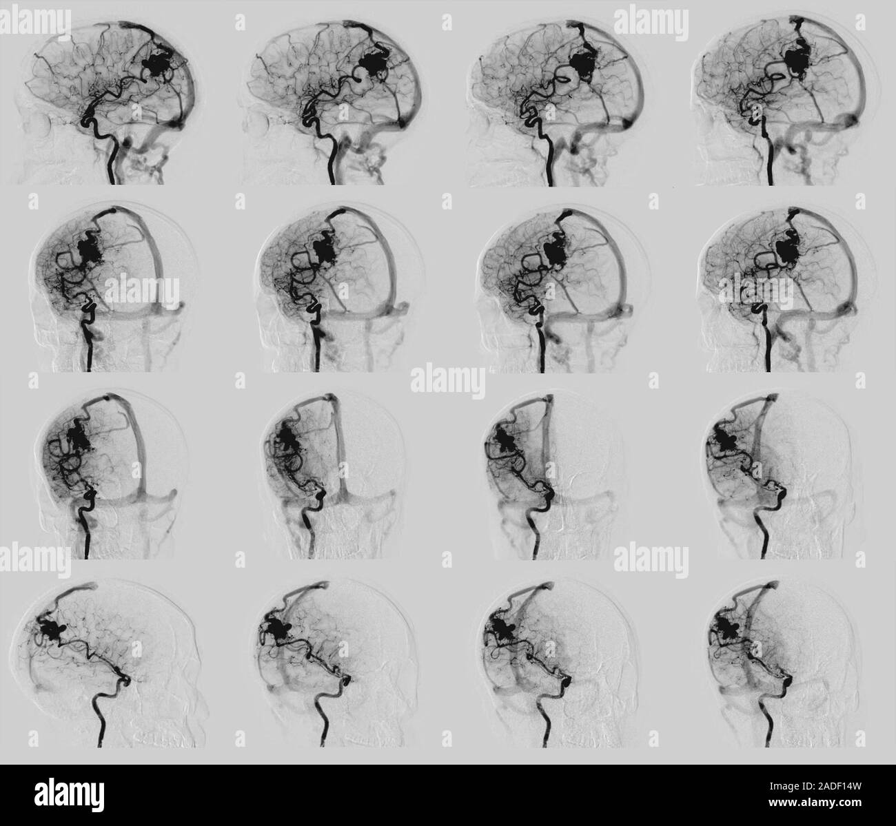 Cerebral arteriovenous malformation. Series of sixteen X-rays of the ...