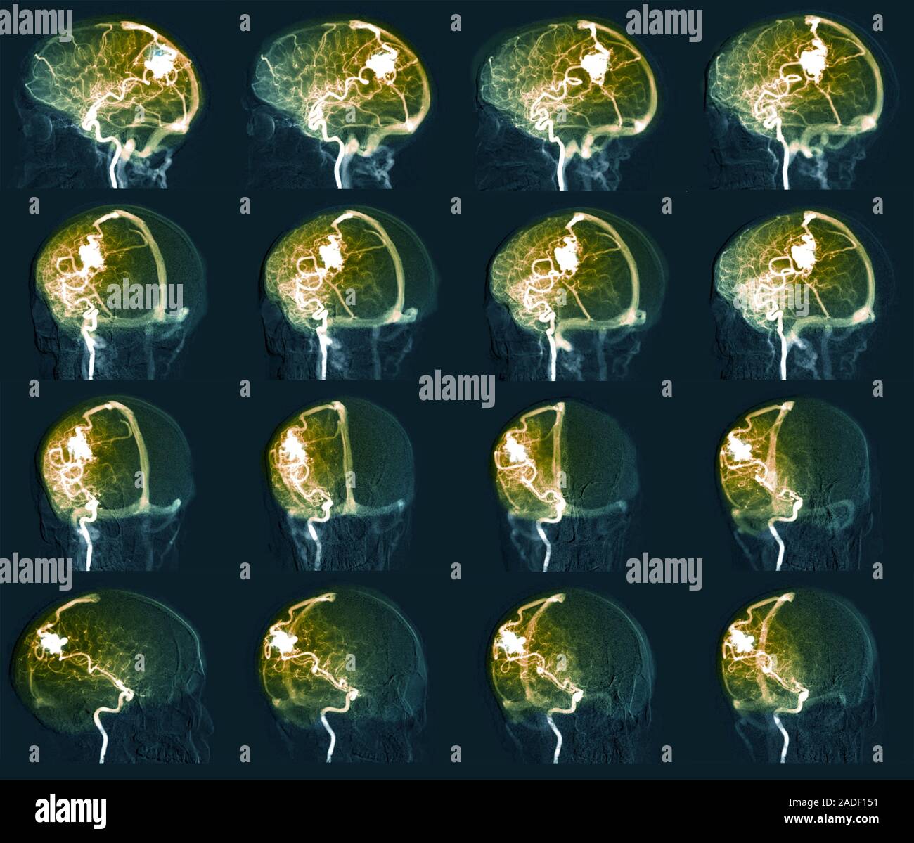 Cerebral arteriovenous malformation. Series of sixteen coloured X-rays ...