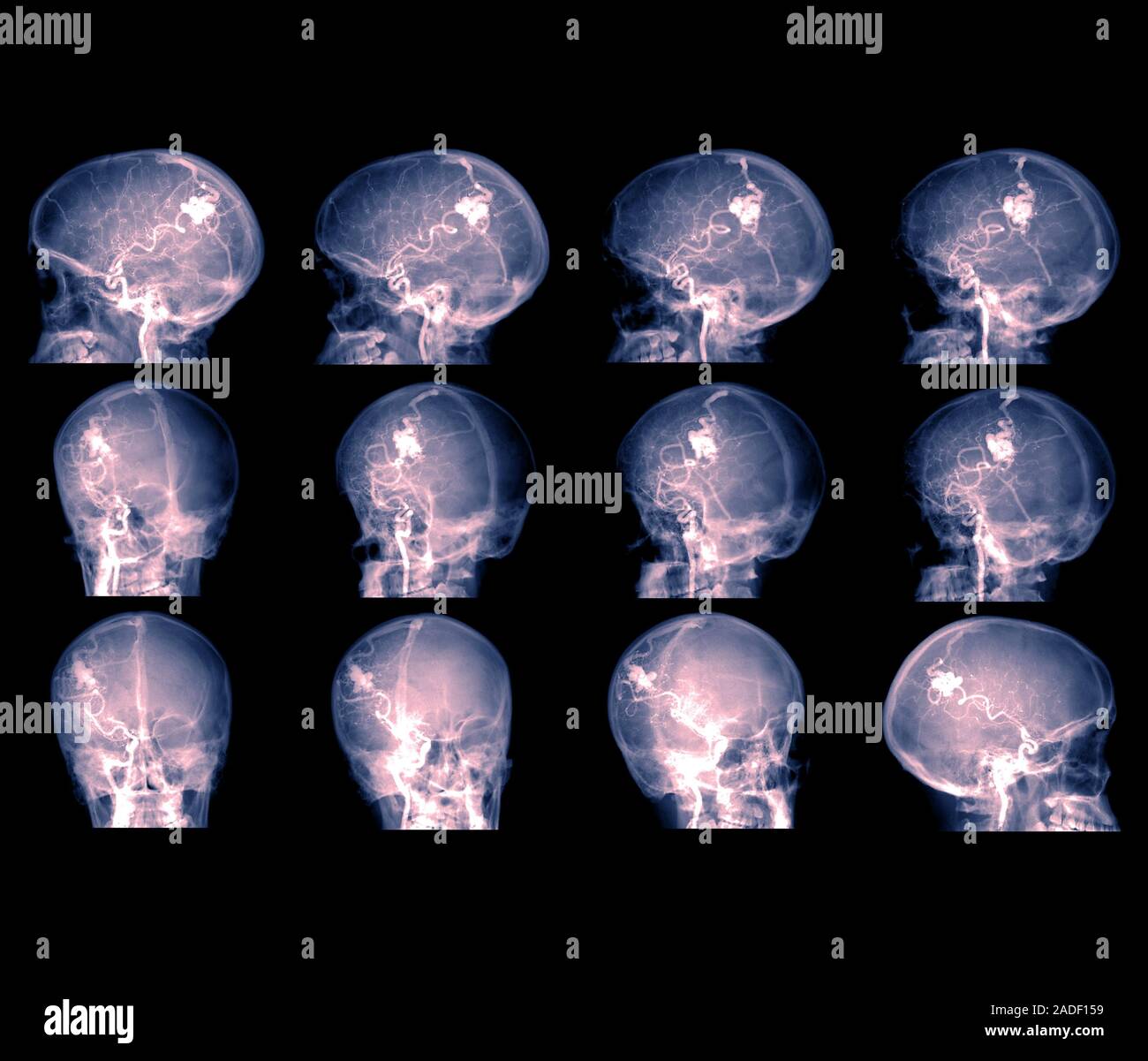 Cerebral arteriovenous malformation. Series of twelve X-rays of the ...