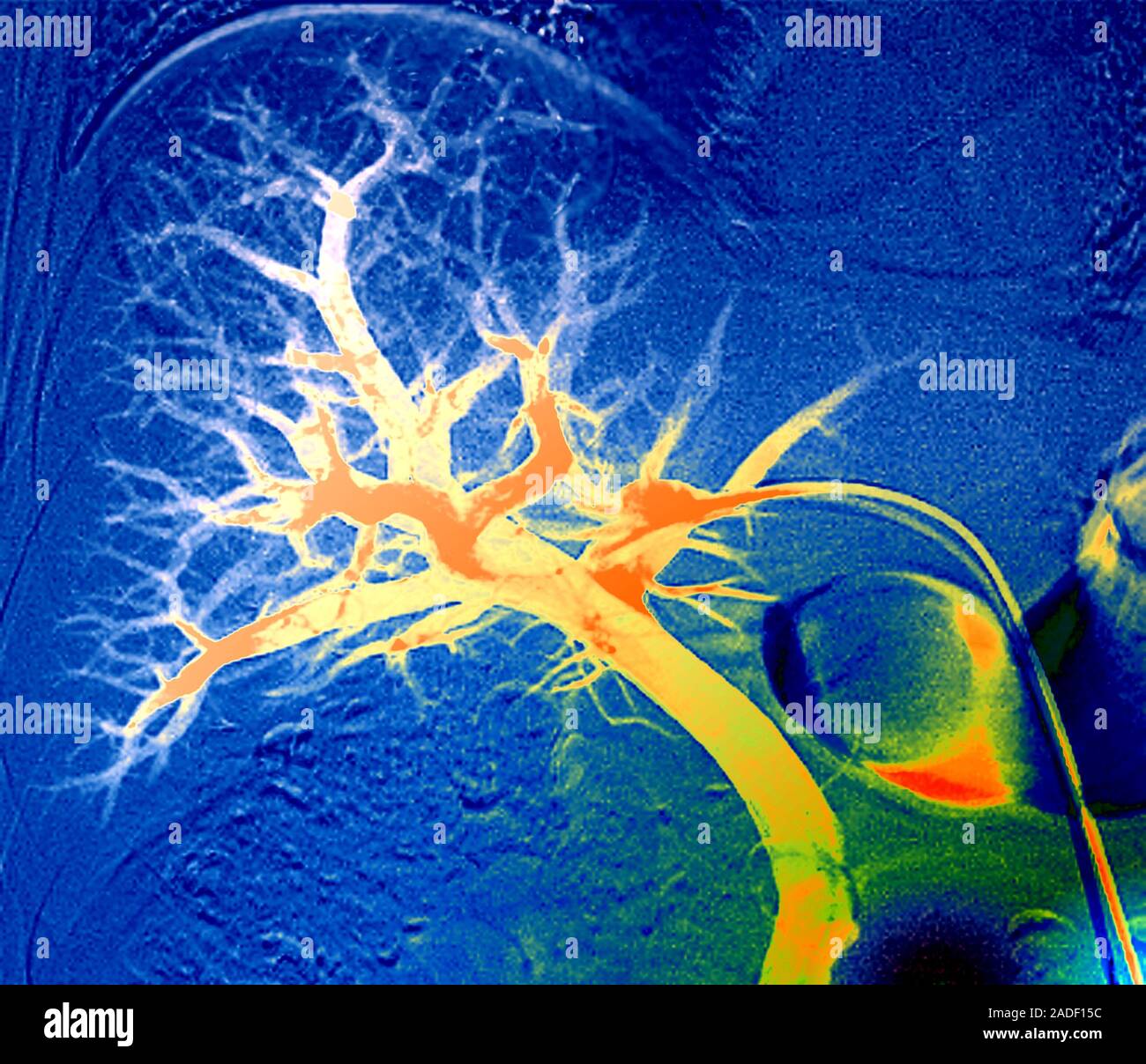 Liver blood vessels. Coloured angiogram (blood vessel X-ray) of the ...