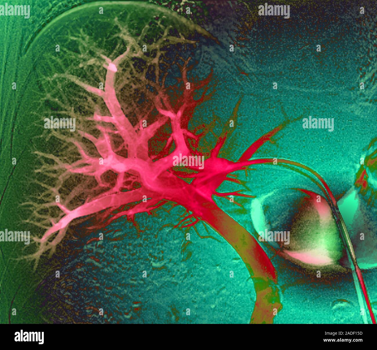 Liver blood vessels. Coloured angiogram (blood vessel X-ray) of the ...