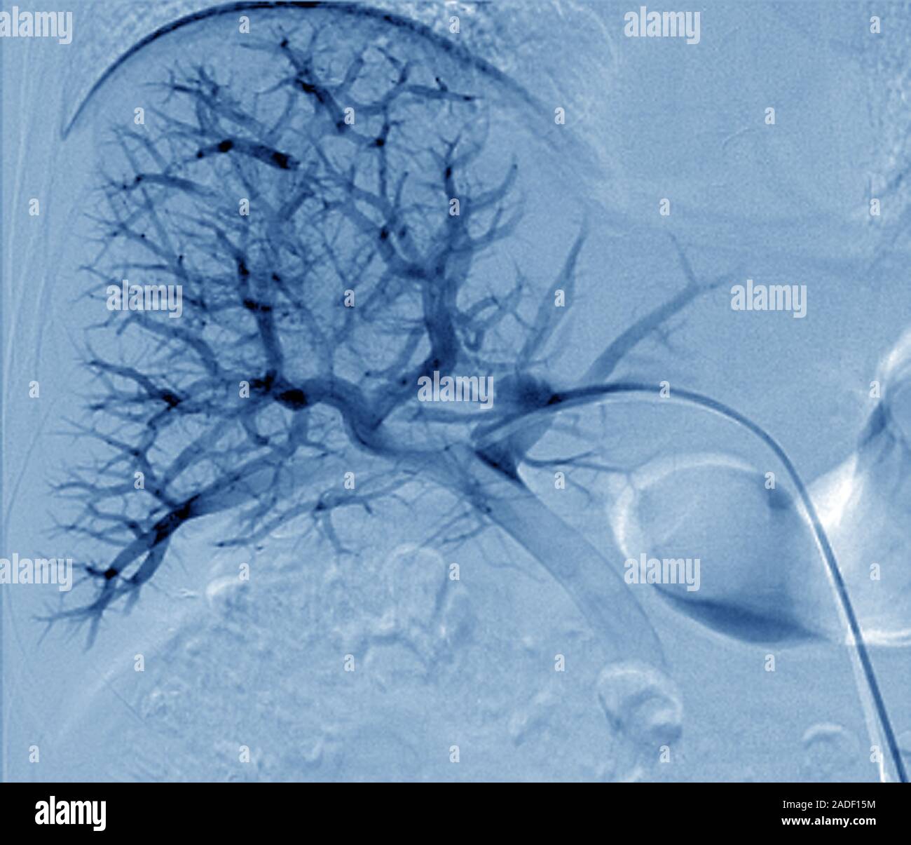Liver blood vessels. Angiogram (blood vessel X-ray) of the blood ...