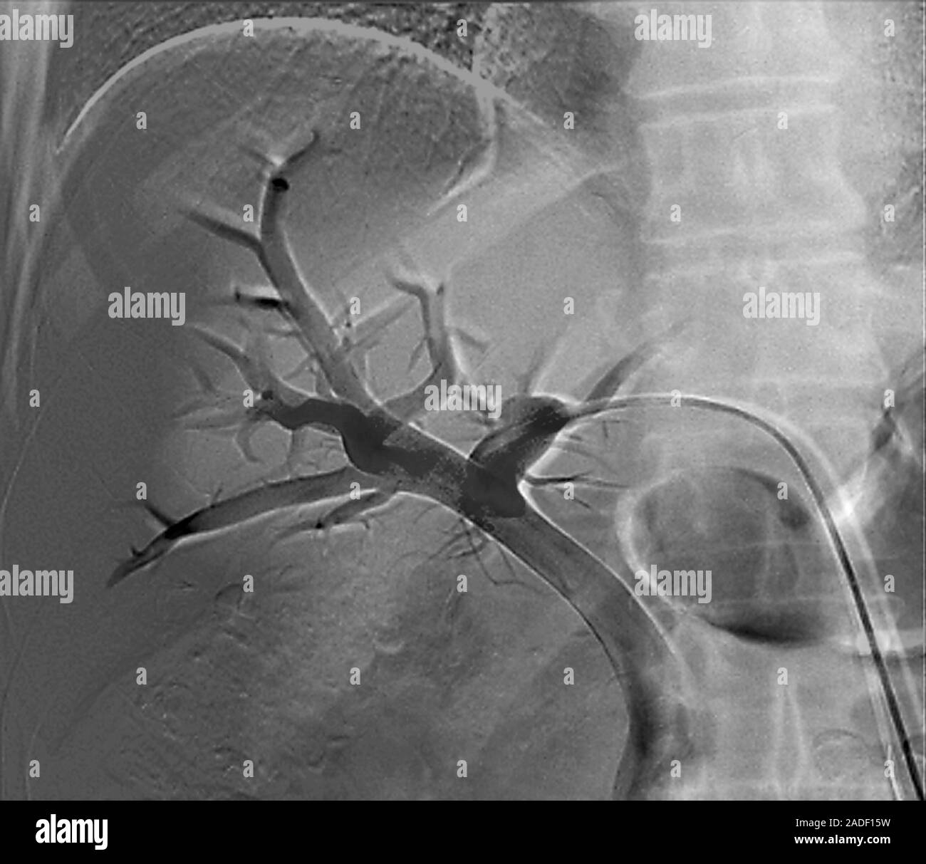 Liver blood vessels. Angiogram (blood vessel X-ray) of the blood ...