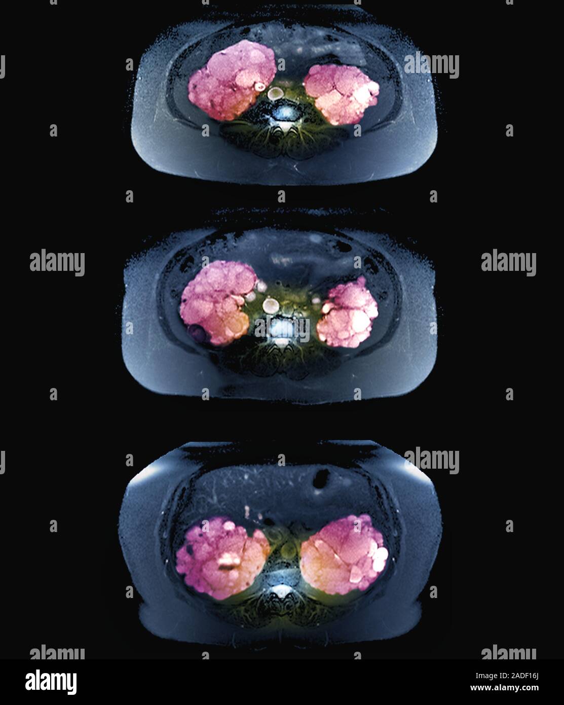 Polycystic kidney disease. Coloured axial magnetic resonance imaging ...