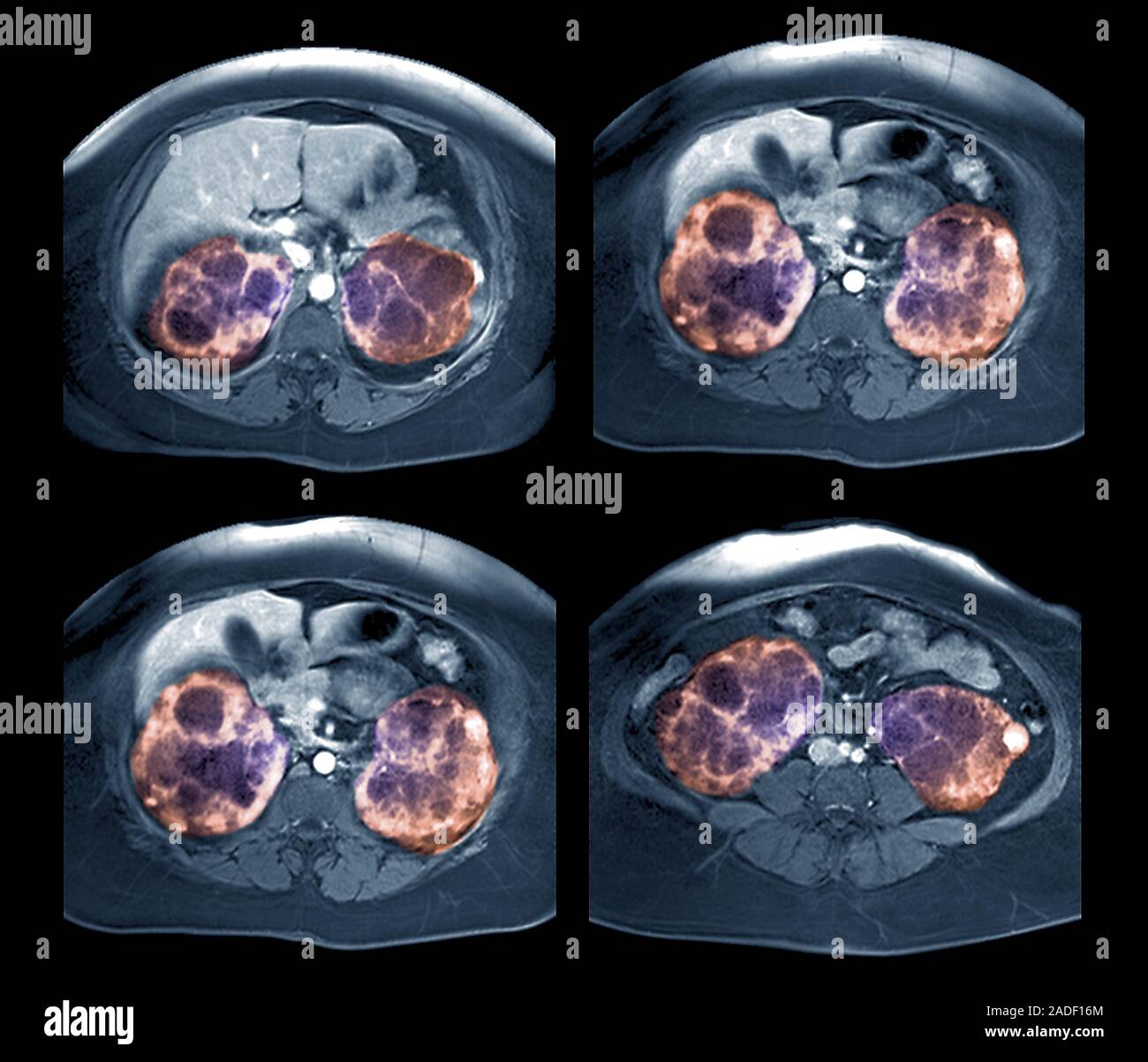 Polycystic kidney disease. Axial magnetic resonance imaging (MRI) scans ...
