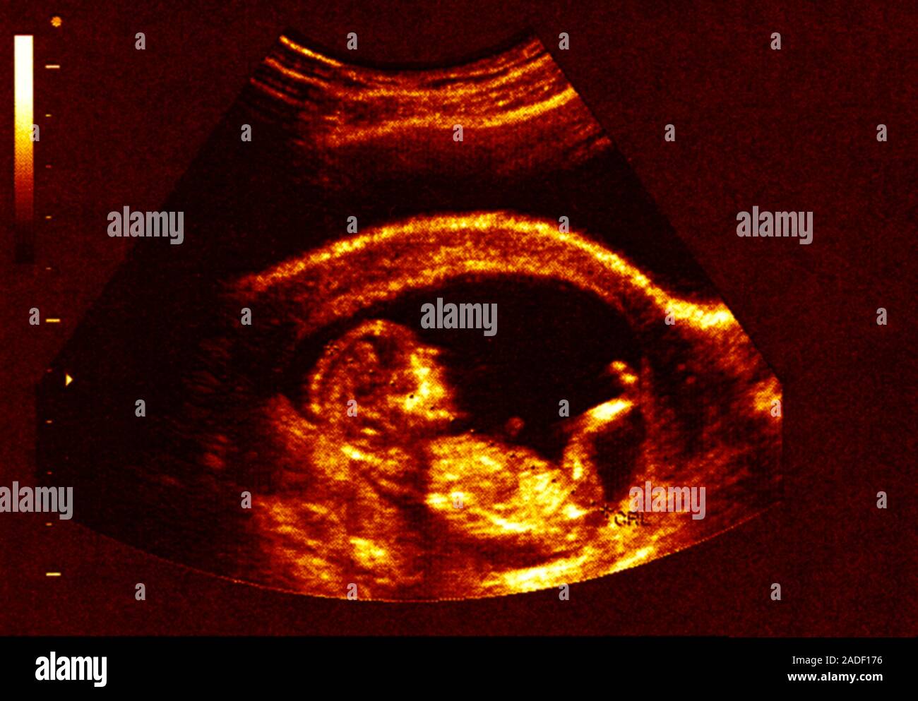 Ultrasound scan of a foetus at 12 weeks. The foetus develops from the ...