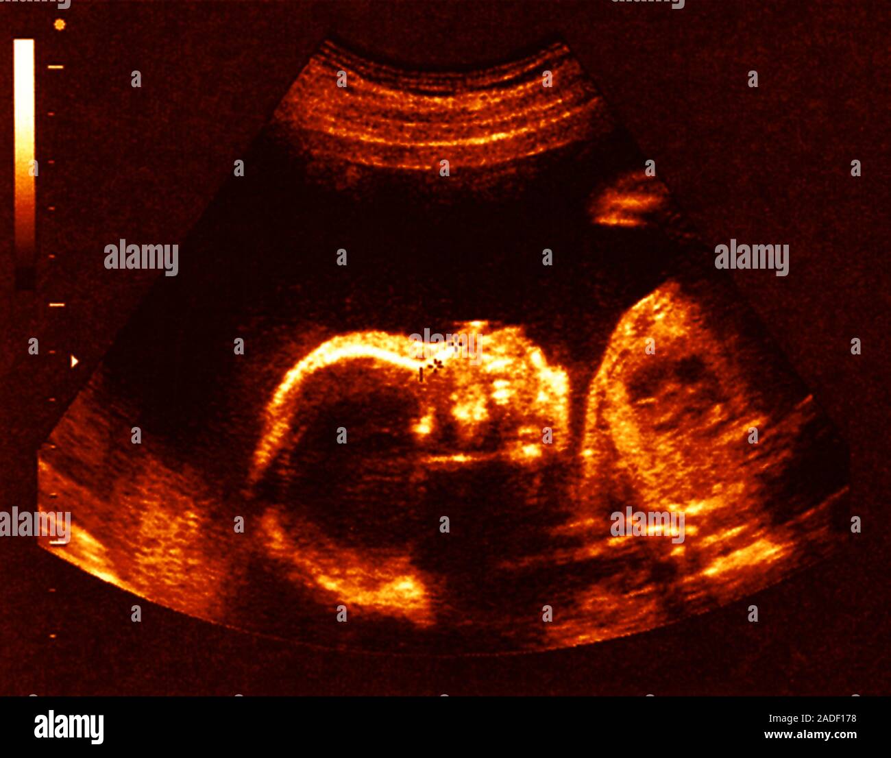 Ultrasound scan of a foetus at 12 weeks. The foetus develops from the ...