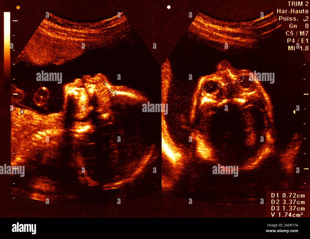 Ultrasound scans of a foetus at 12 weeks. The foetus develops from the ...