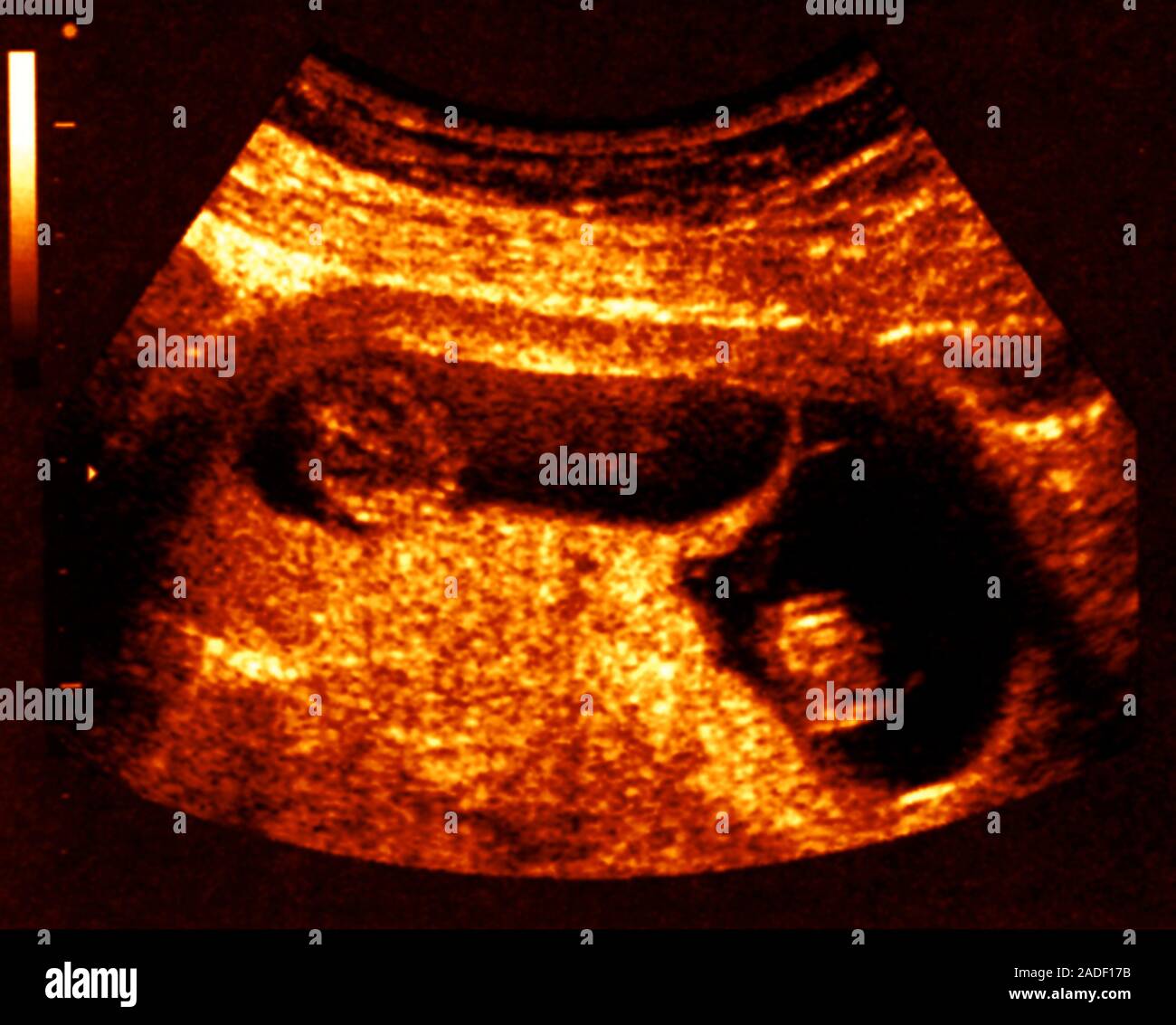 Ultrasound scan of twin foetuses at 9 weeks. The foetus develops from ...