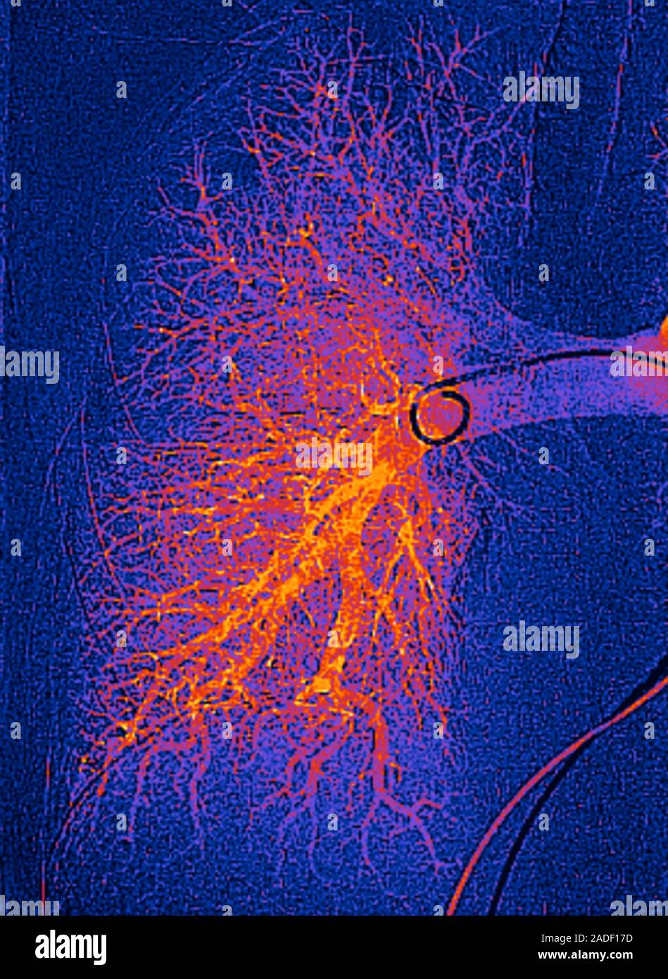 Lung blood vessels, coloured angiogram (blood vessel X-ray). The ...
