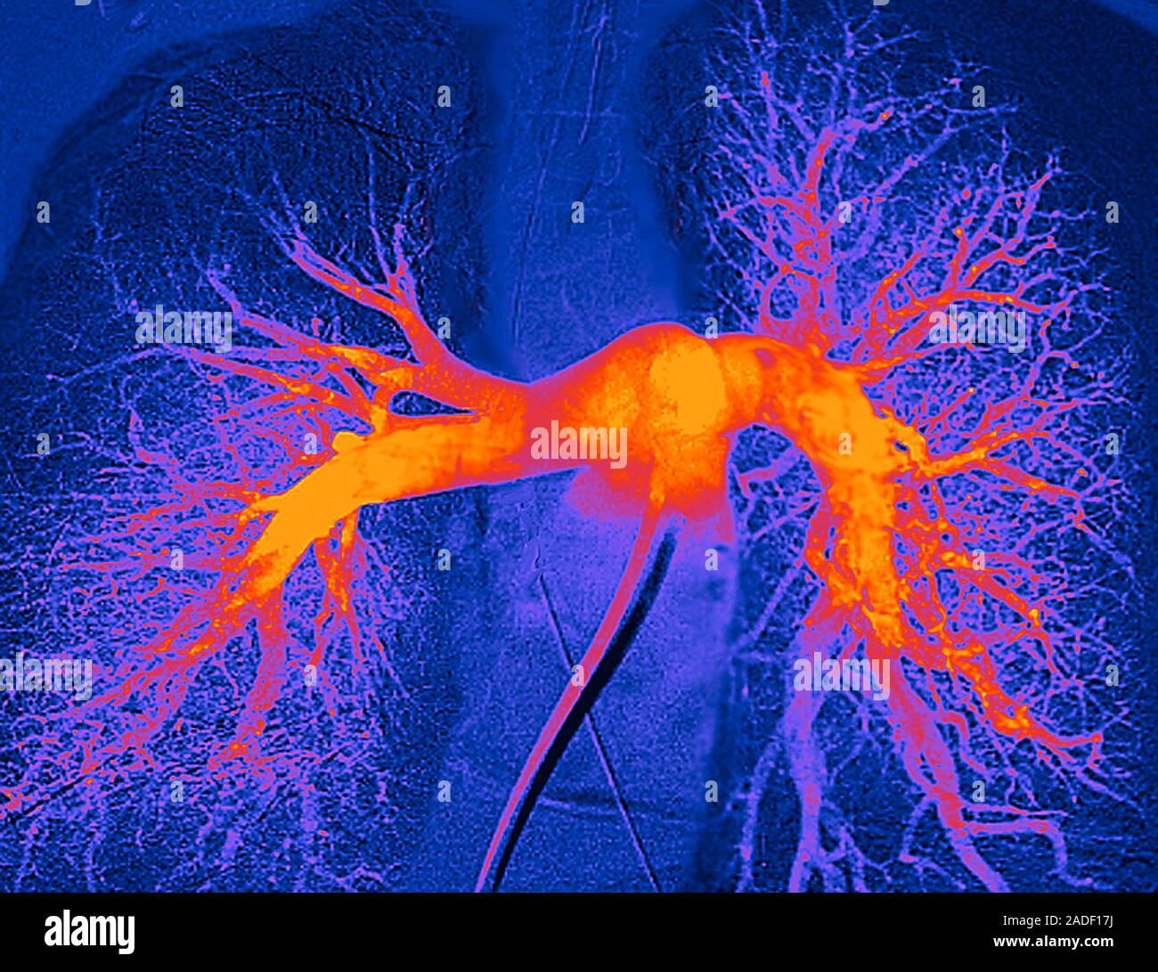 Lung blood vessels, coloured angiogram (blood vessel X-ray). The ...