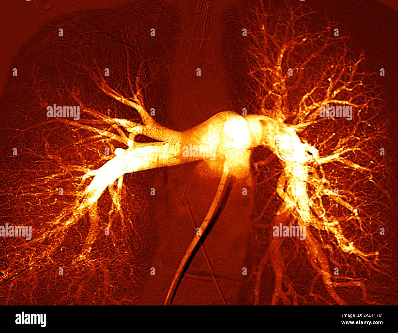 Lung blood vessels, coloured angiogram (blood vessel X-ray). The ...