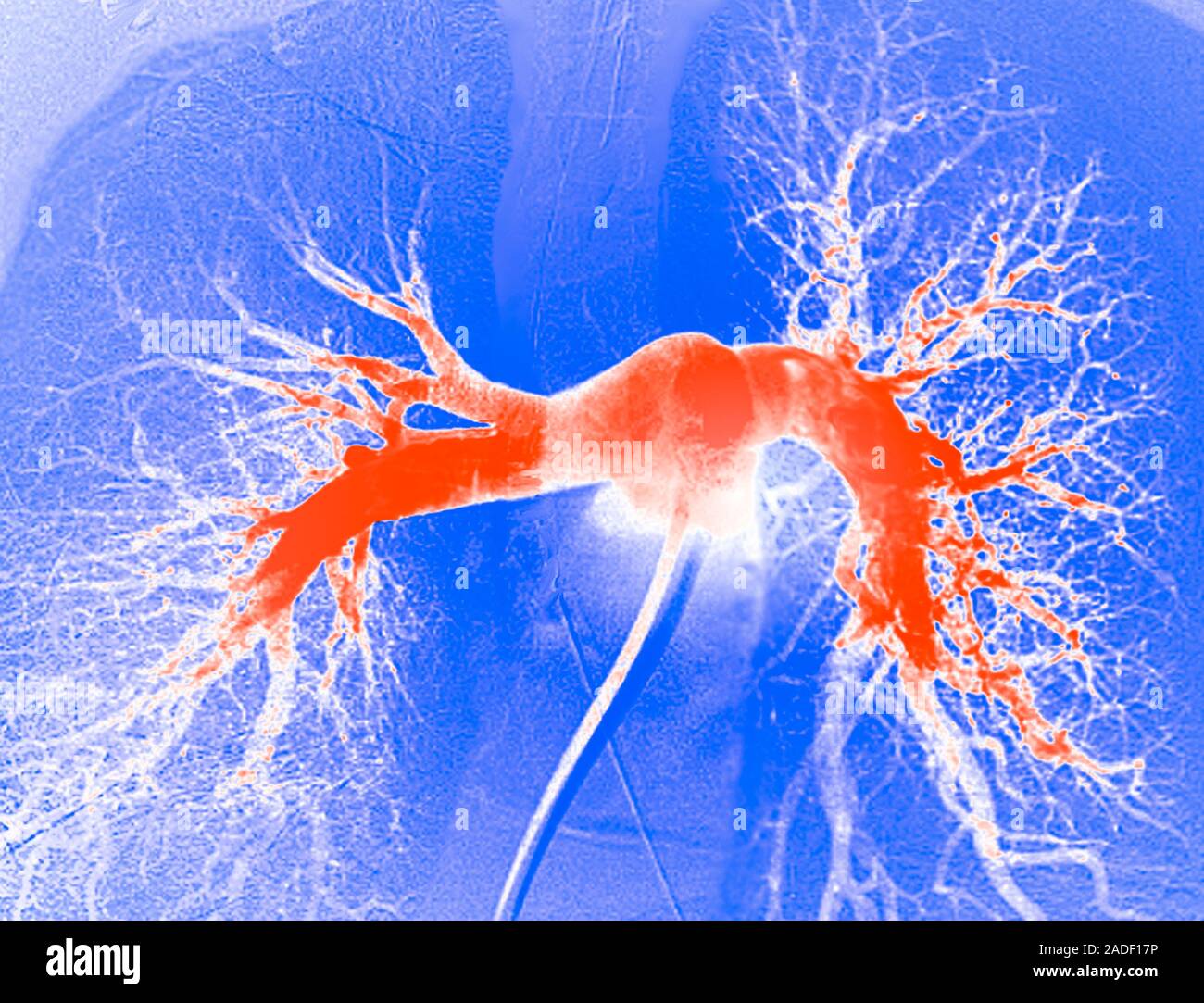 Lung blood vessels, coloured angiogram (blood vessel X-ray). The ...