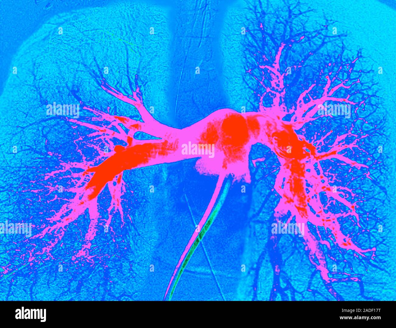 Lung blood vessels, coloured angiogram (blood vessel X-ray). The ...