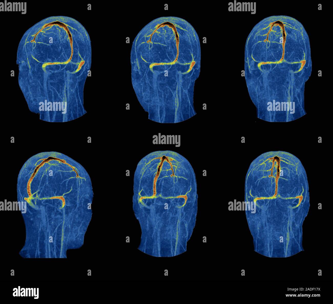 Brain veins and venous sinuses. Coloured 3D angiograms (blood vessel X ...