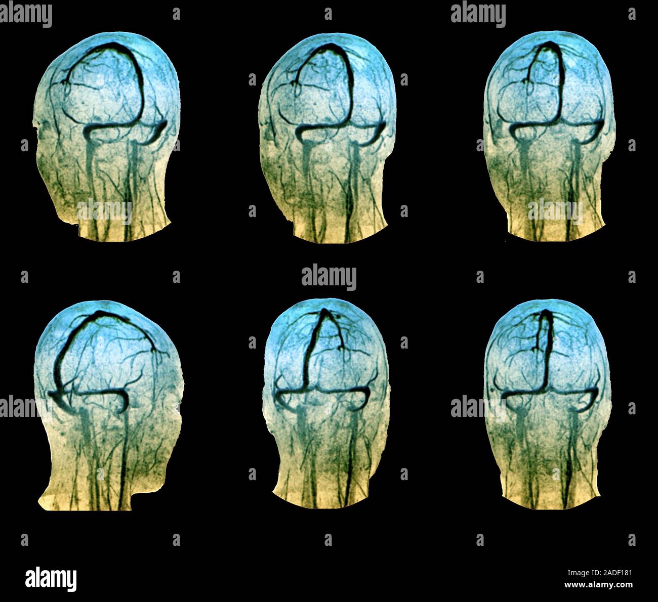 Brain veins and venous sinuses. Coloured 3D angiograms (blood vessel X ...