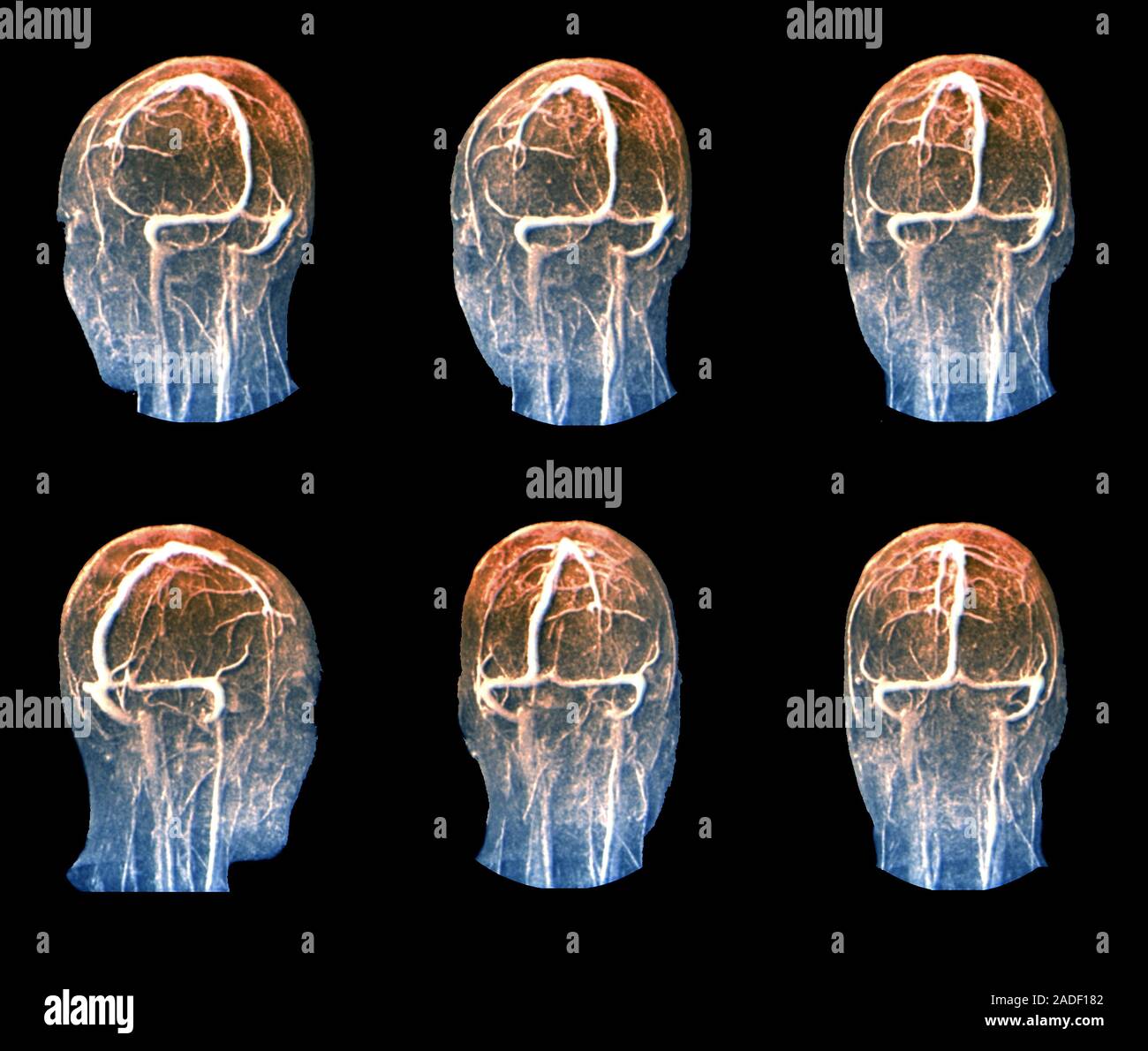 Brain veins and venous sinuses. Coloured 3D angiograms (blood vessel X ...